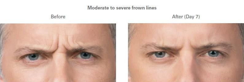 Botox For Men In New Orleans And Baton Rouge Qna Cosmetic Surgery