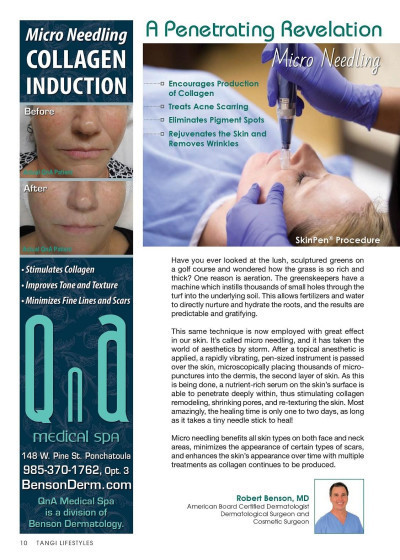 Micro Needling- A Penetrating Revelation | QnA Cosmetic Surgery ...