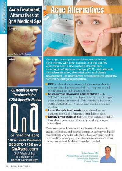 Acne Alternatives | QnA Cosmetic Surgery & Medical Spa