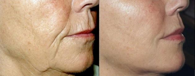 Sculptra Dermal Filler | QnA Cosmetic Surgery & Medical Spa