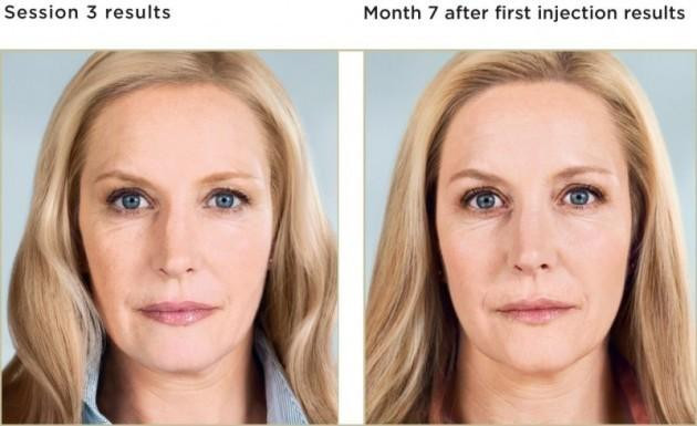 Sculptra Dermal Filler | QnA Cosmetic Surgery & Medical Spa