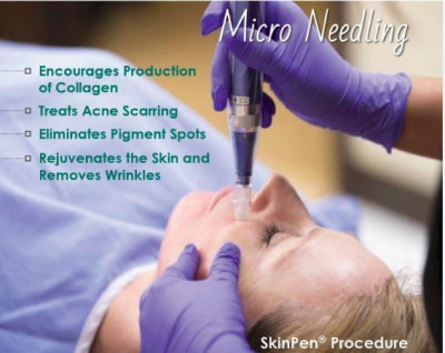 Micro Needling- A Penetrating Revelation | QnA Cosmetic Surgery ...
