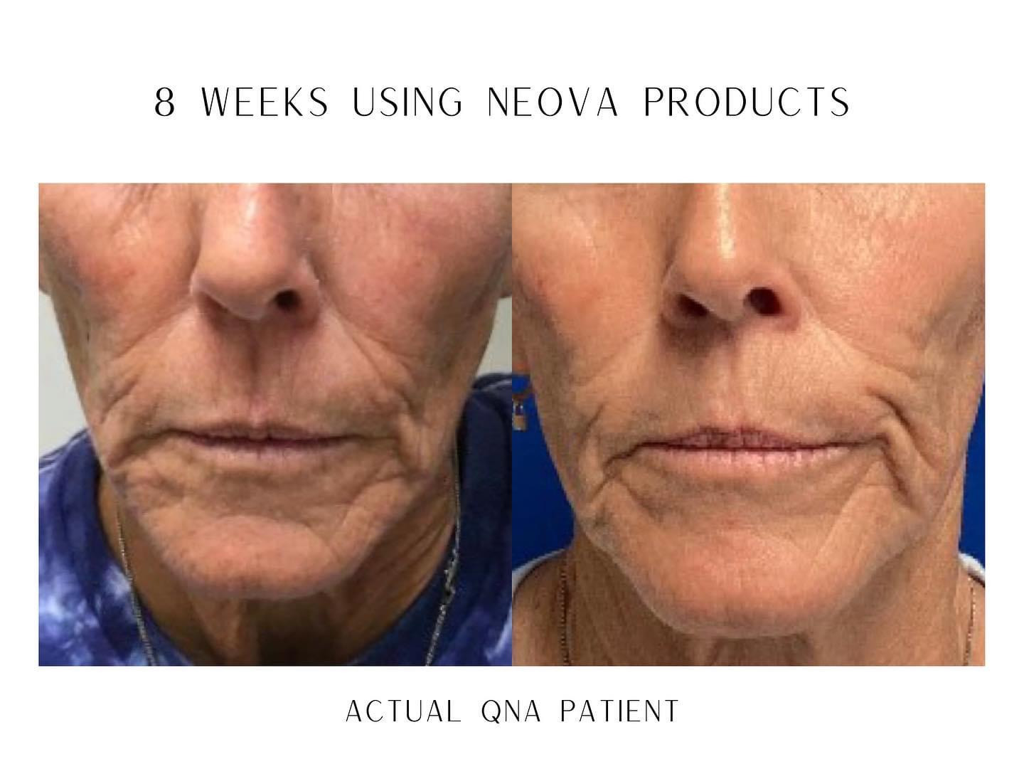 NADIA - Products | QnA Cosmetic Surgery & Medical Spa